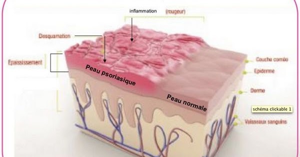 Psoriasis : plaques rouges à certains endroits du corps