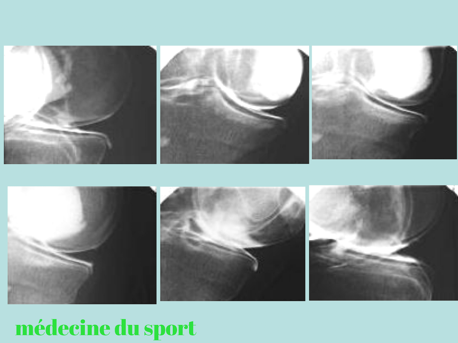 IMAGERIE DU GENOU APPLIQUÉE A LA PATHOLOGIE SPORTIVE