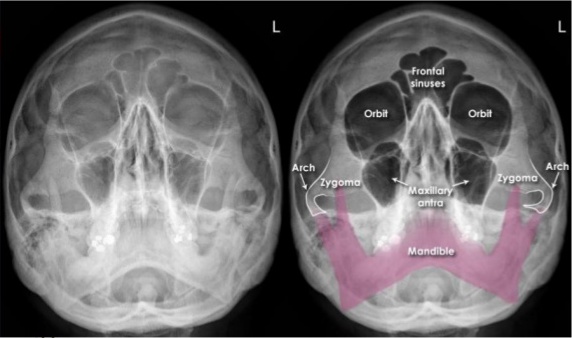 White Tower・White Jungle: [外科筆記] 整型外科・顏面骨骨折・Facial Bone Fracture