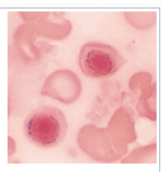 Sideroblastic Anaemia - pediagenosis