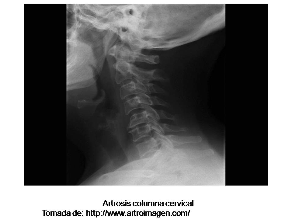 Diagnóstico de la artrosis
