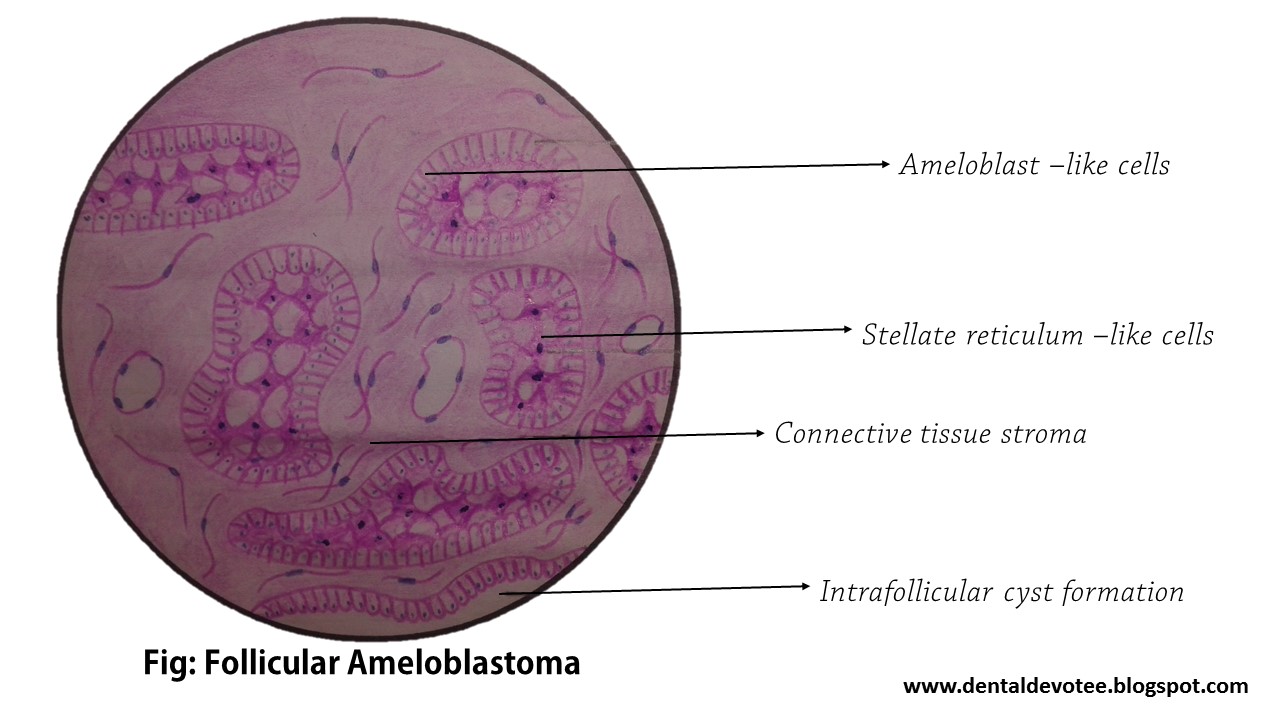 Plexiform Ameloblastoma Histology