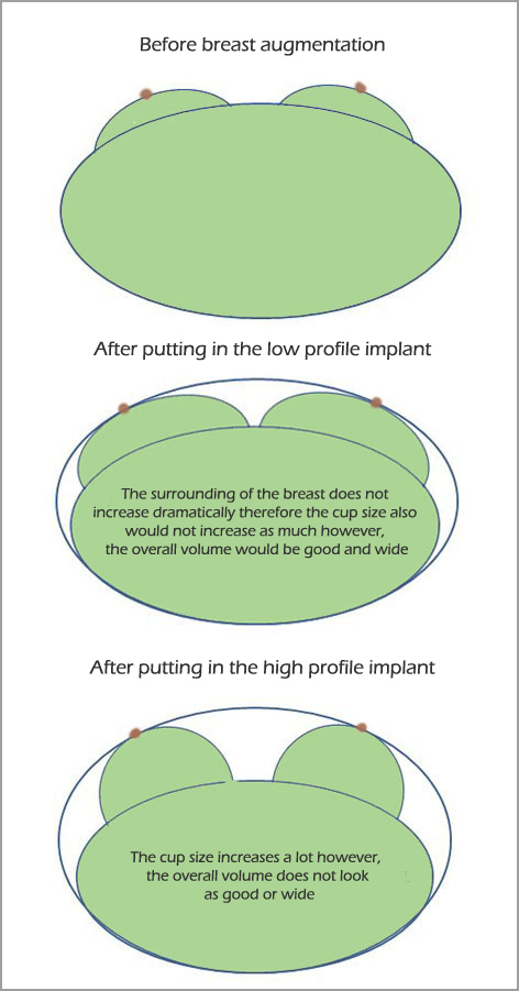 Breast Augmentation Before And After High Profile