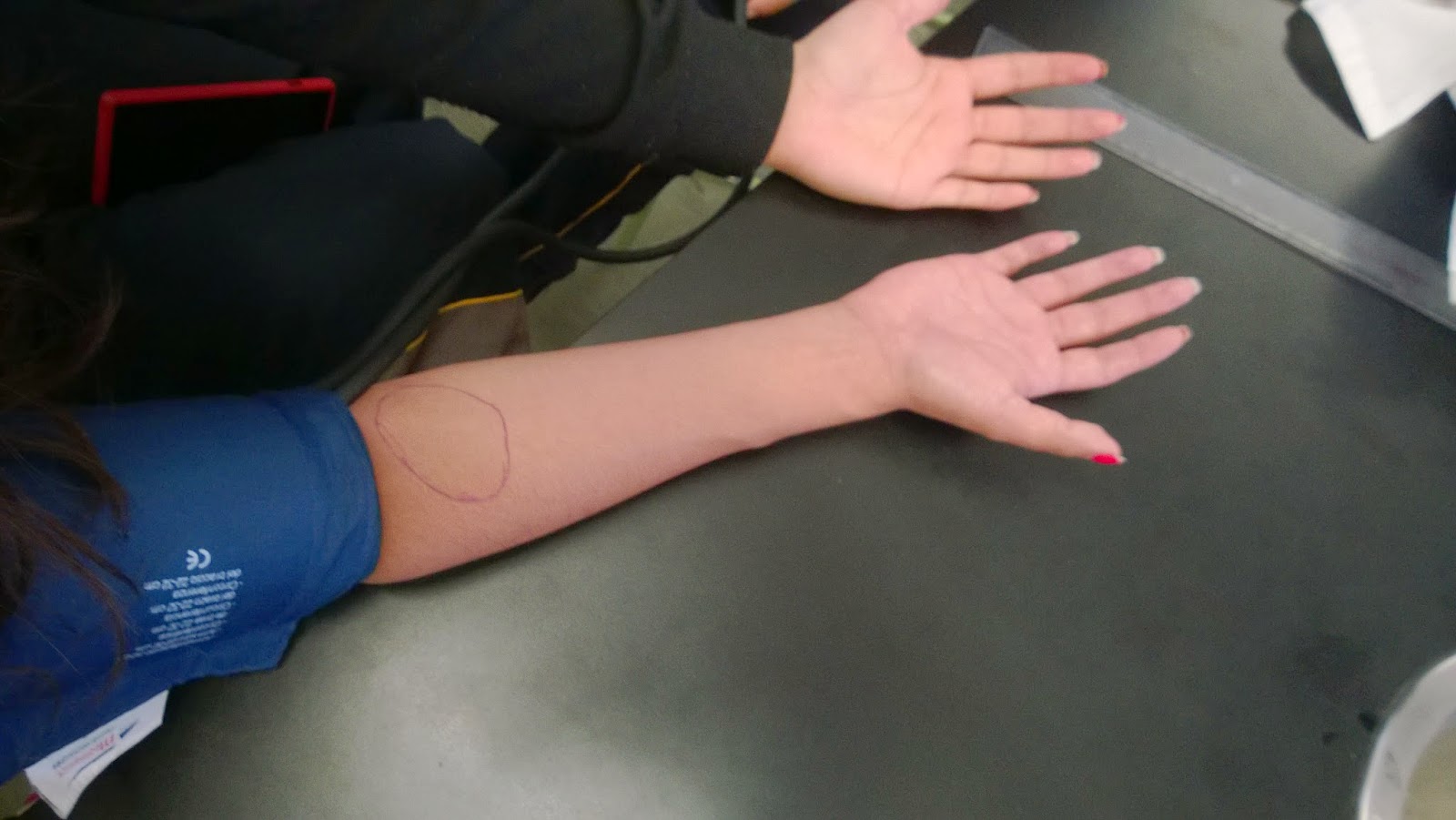 PRUEBA DE RUMPEL-LEE: PRUEBA DE RUMPEL-LEEDE