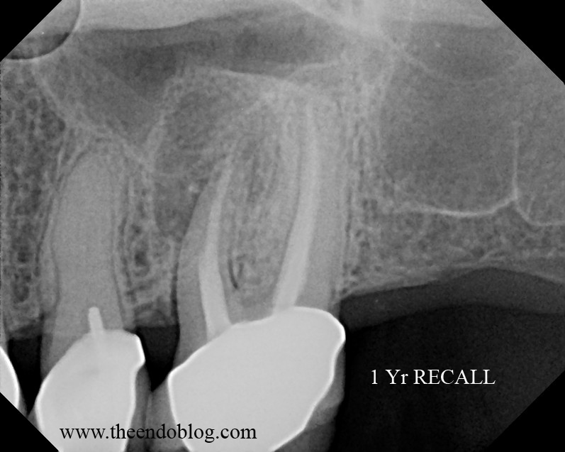 Apical Surgery for Complete Endodontic Healing | Bridgers Blog