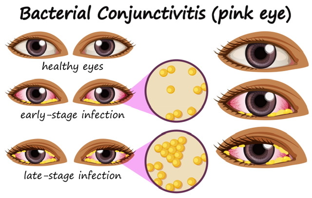Facts about the “pink eye”