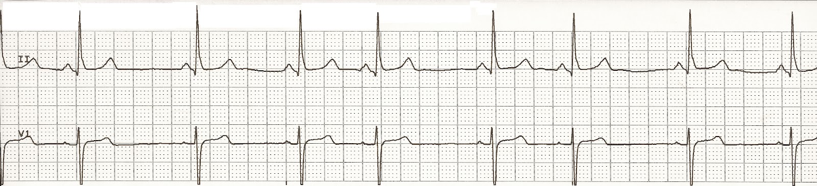 EKG Rhythm Strips 15: Sinus Rhythms