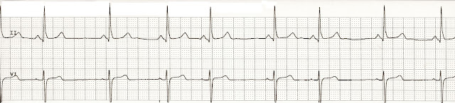 EKG Rhythm Strips 15: Sinus Rhythms