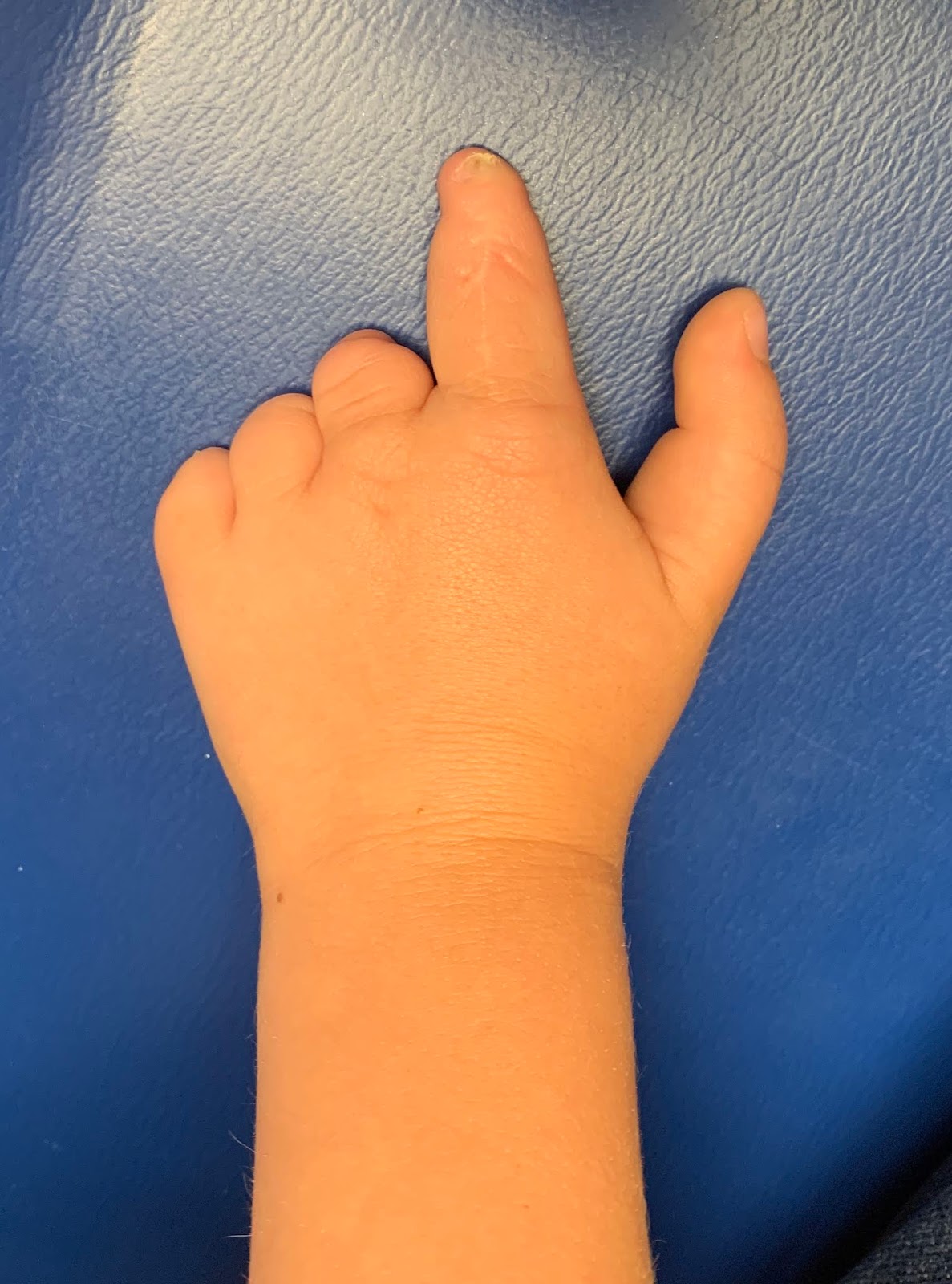 Only a thumb. Amazing outcome! | Congenital Hand and Arm Differences ...