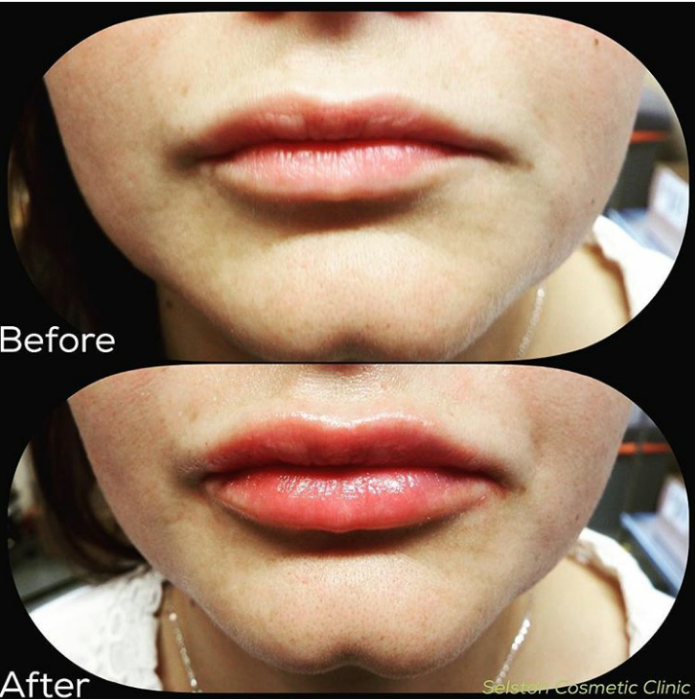 Selston Cosmetic Clinic: Beautiful Natural Looking Enhanced Lips at ...