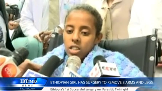 Ethiopian News: Ethiopian Doctors successful surgery on 'Parasitic Twin ...