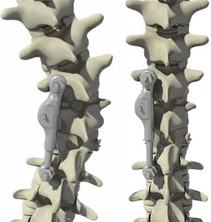 Scoliosis Surgery Frequently-Asked Questions | Growing Spine Blog ...