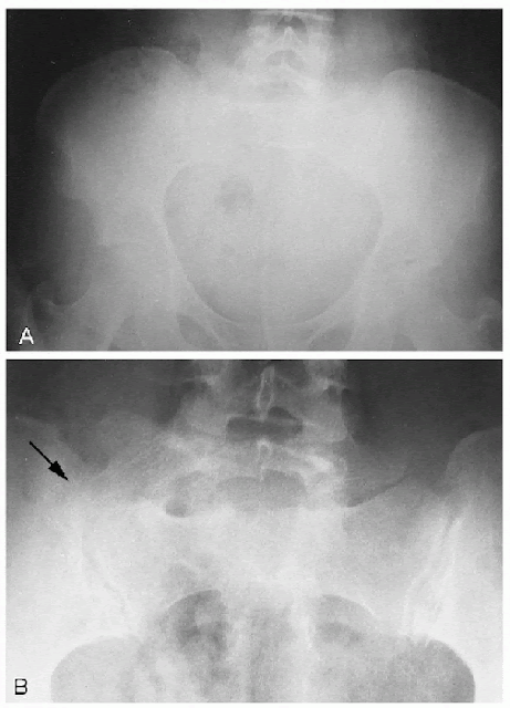 Ultimate Radiology : Lumbosacral transitional vertebrae
