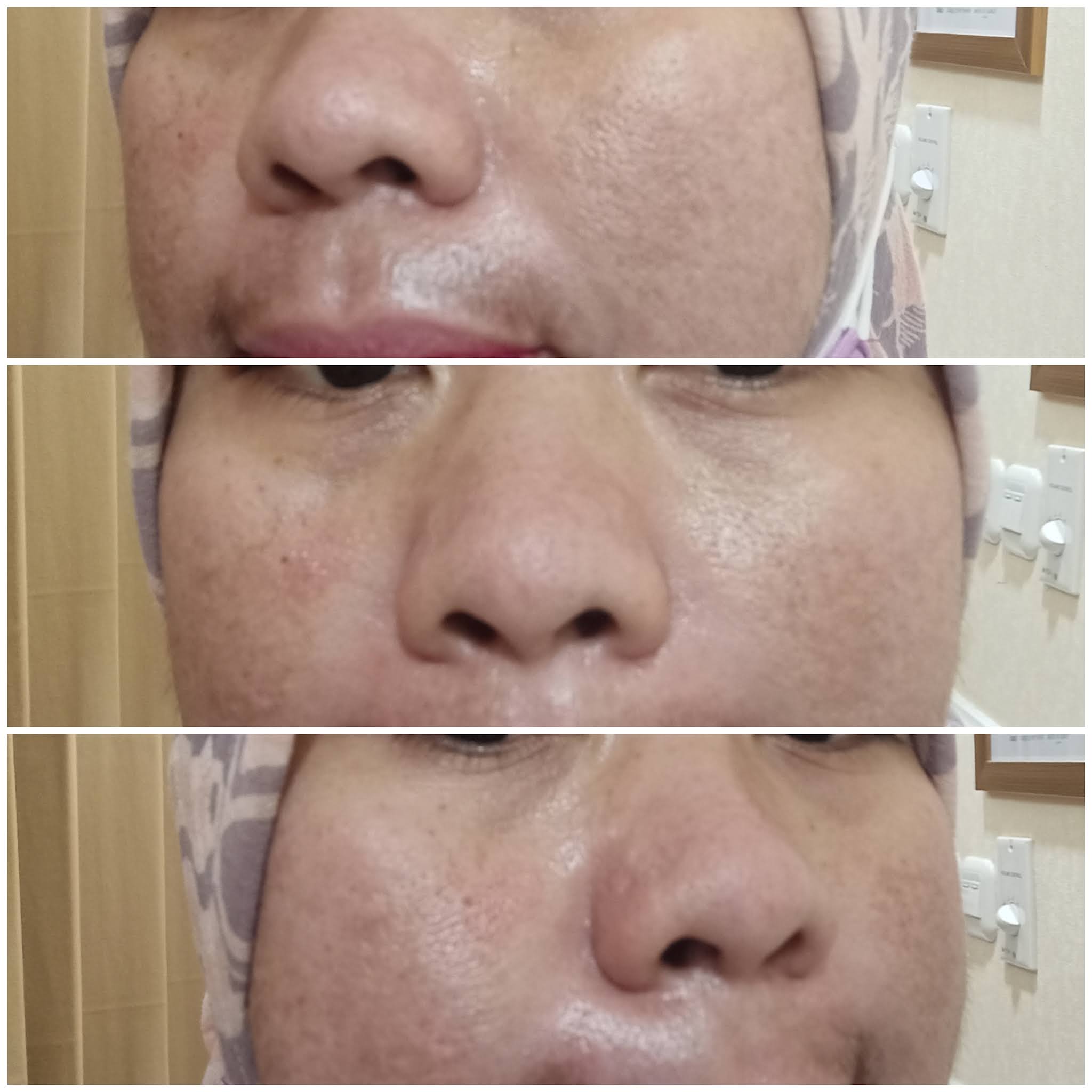 Flek Blocker Treatment ZAP Clinic Ampuh Cegah Flek Hitam Usia 40 Tahun