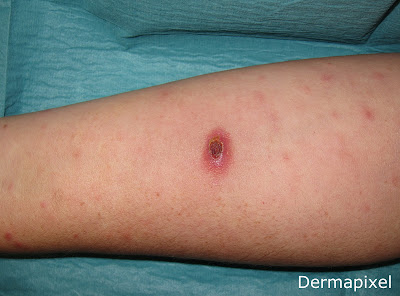 Dermapixel: diciembre 2017