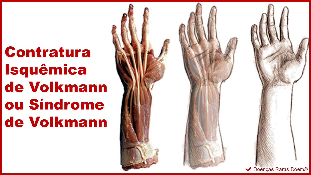 Contratura Isquêmica De Volkmann - RETOEDU