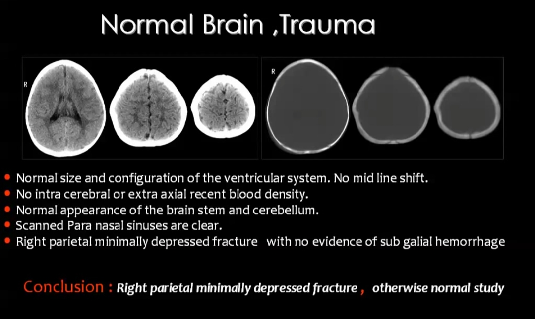 CT brain Trauma :: how to report :: Dr.Mamdouh Mahfouz