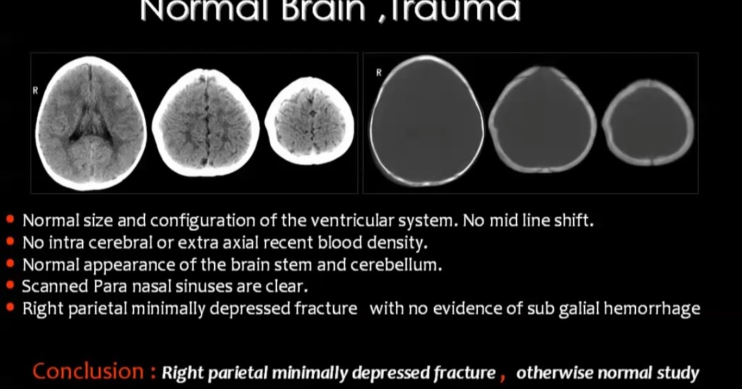 CT brain Trauma :: how to report :: Dr.Mamdouh Mahfouz