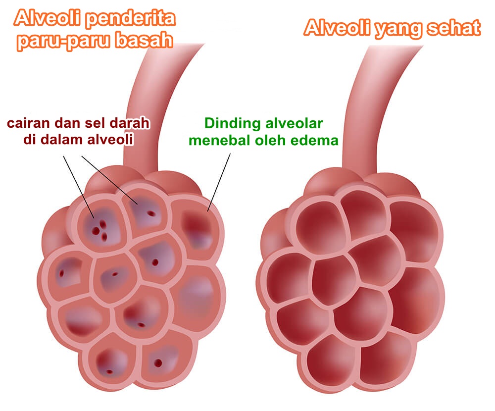 Pengobatan Paru Paru Basah Secara Alami ~ Walatra Gamat Emas