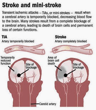 Cegah minor stroke dari berulang dengan hanya 1 supplement - Story of ...