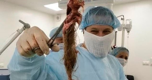 Ovari Wanita Dipenuhi Rambut, Fenomena Aneh dan Jarang Berlaku