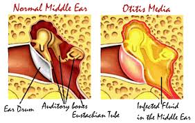 Beberapa Jenis Gangguan dan Penyakit Pada Organ Telinga Tengah ...