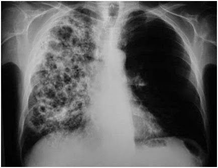 Histoplasmose || Med-koM