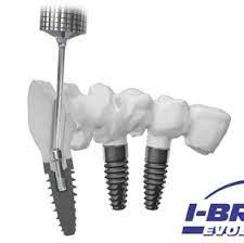 When to employ angled screw channels for implant restorations?