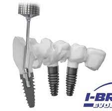 When to employ angled screw channels for implant restorations?