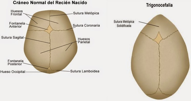 Síndrome de Opitz C - Ciencia Bizarra
