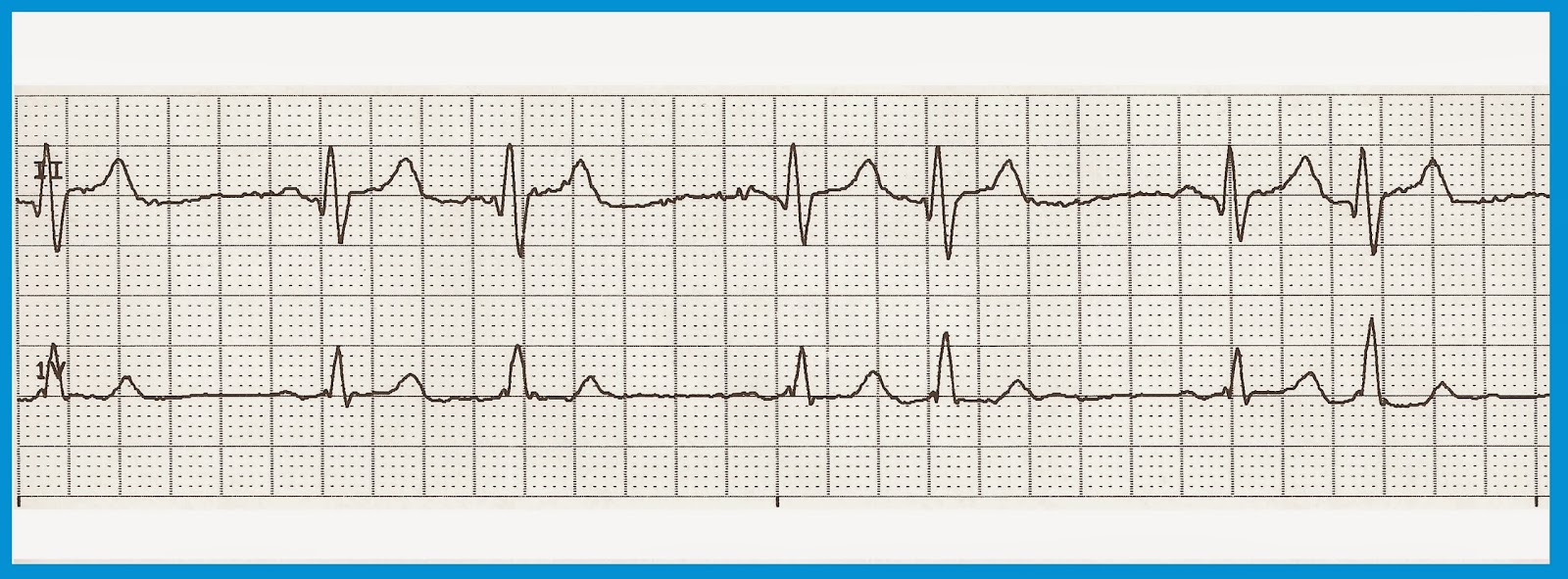 Practice EKG Rhythm Strips 215