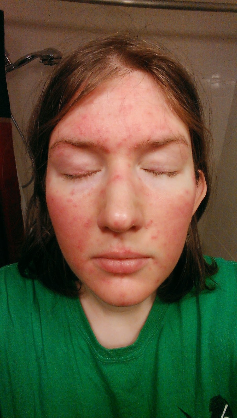 Prosacea Review: February 2015