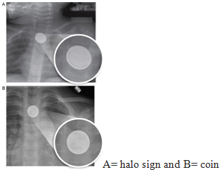 FOREIGN BODY ESOPHAGUS PART 2 (BUTTON BATTERY)