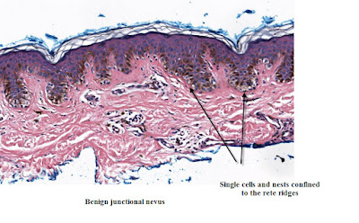 Dermpath Made Simple - Neoplastic: Benign Nevi