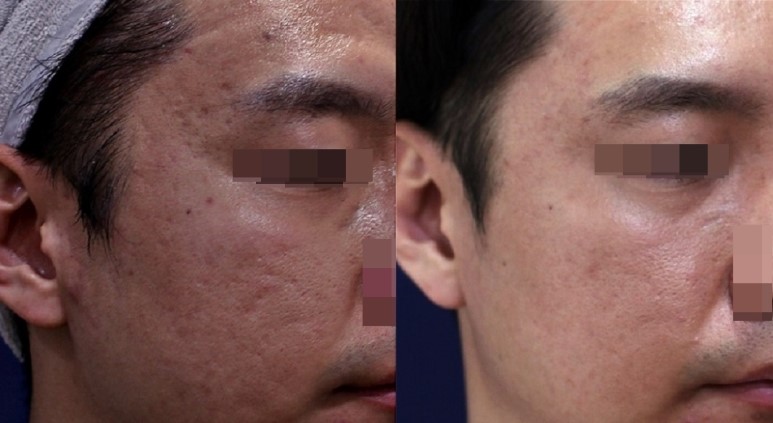 Renewme Skin Clinic: NEW 2019 Acne scar treatment; DNA Dermal Rejuvenation