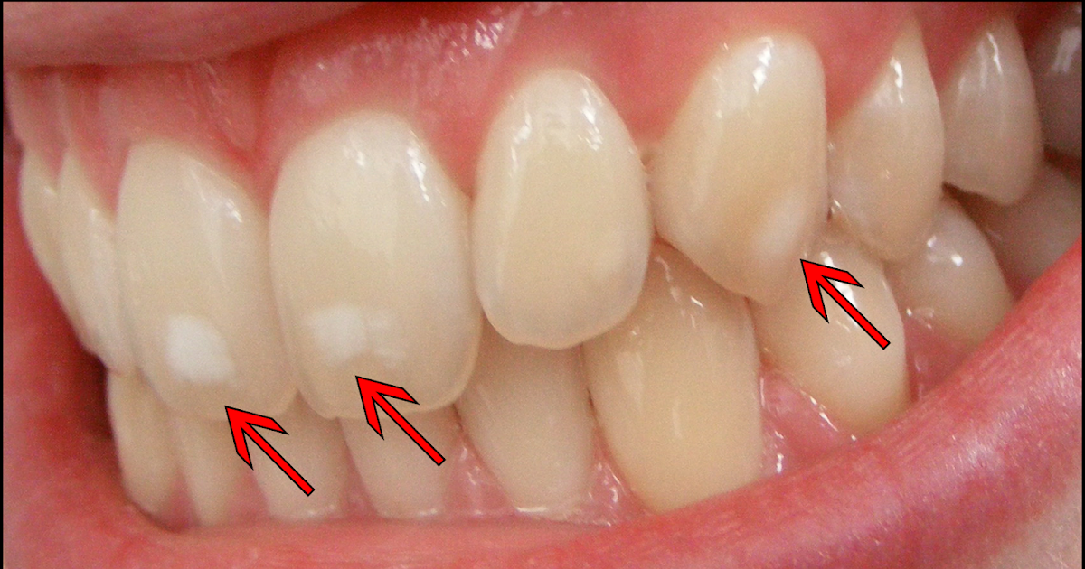 Fluorose Dentária - Características Clínicas e Índice de Dean