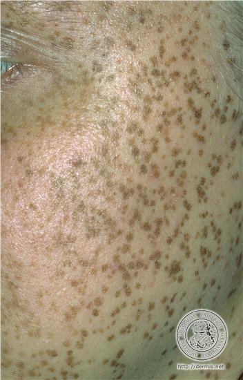 Anatomy and Physiology: LEOPARD Syndrome