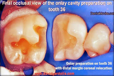 OPERATIVE DENTISTRY: Onlay preparation on tooth 36 with distal margin ...