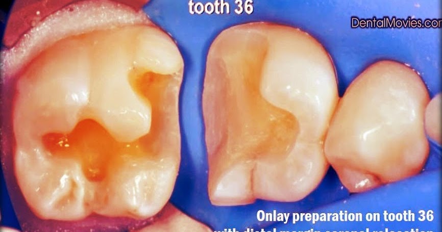 OPERATIVE DENTISTRY: Onlay preparation on tooth 36 with distal margin ...