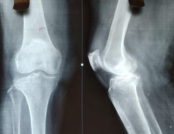 Joint Preservation and Replacement : Arthroscopic Assisted Lateral ...
