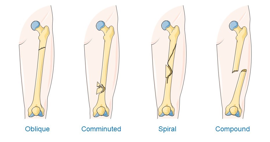 Open Fracture Treatment | Open Bone Fracture Surgery