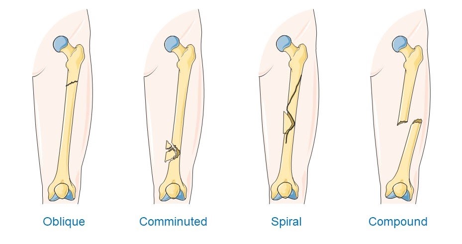 Open Fracture Treatment | Open Bone Fracture Surgery