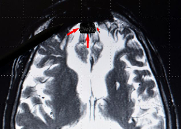 The Neurocritic: The 'evil patch' in the brain's central lobe