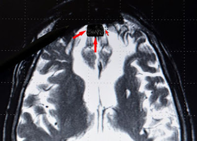 The Neurocritic: The 'evil patch' in the brain's central lobe