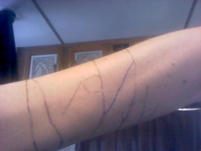 Cameo Garrett: (Photos) Scars from Knife and Razor Wounds (Updated)