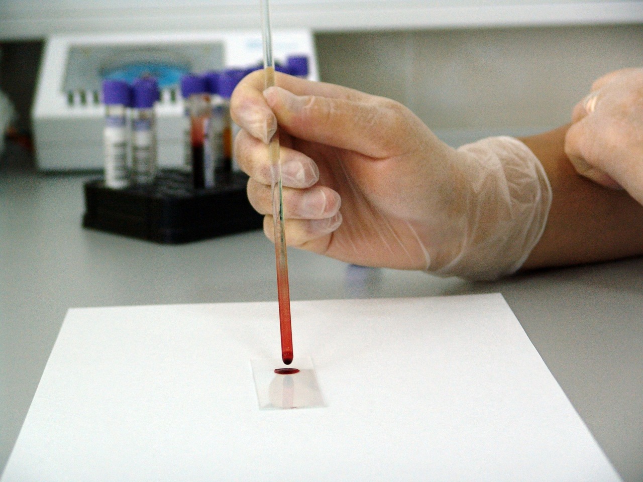 Erythrocyte Sedimentation Rate (ESR test )