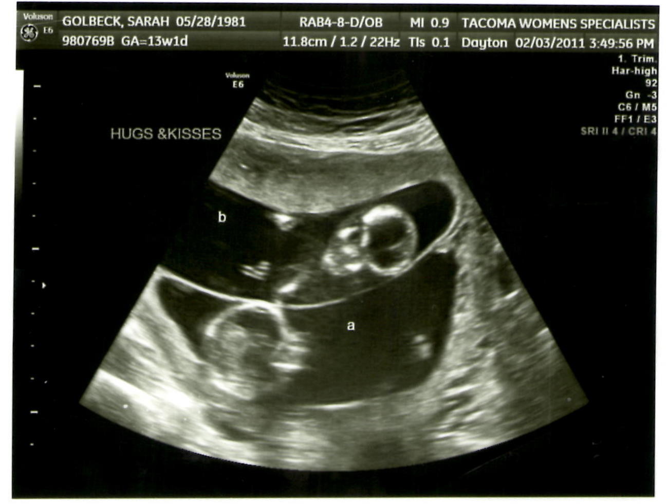 The Golbecks: Ultrasound 13 weeks