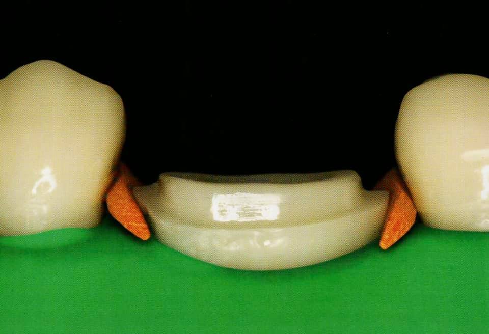 Endocrown .. part 2 | Dental Esthetics