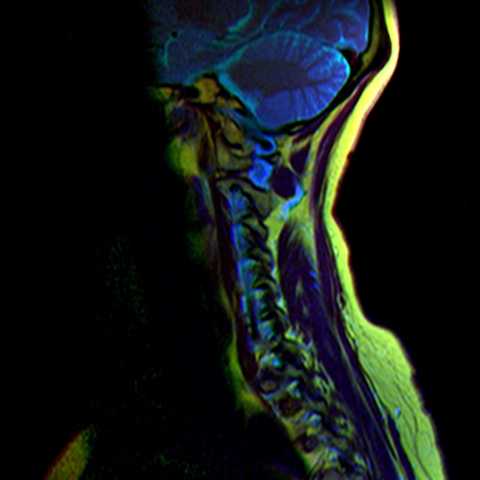 Nevit's blog: Cervical spine Color MRI