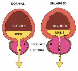 Patofisiologi BPH (Benigna Prostat Hiperplasia) - Medianers